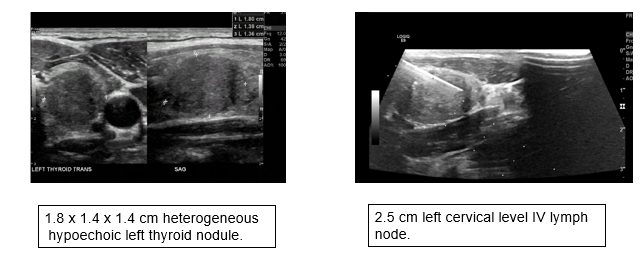 Thyroid Ultrasound Cancer