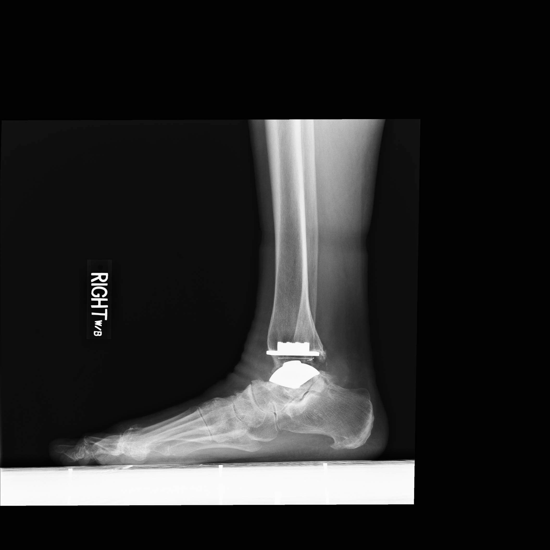 Total Ankle Arthroplasty | UPMC Physician Resources