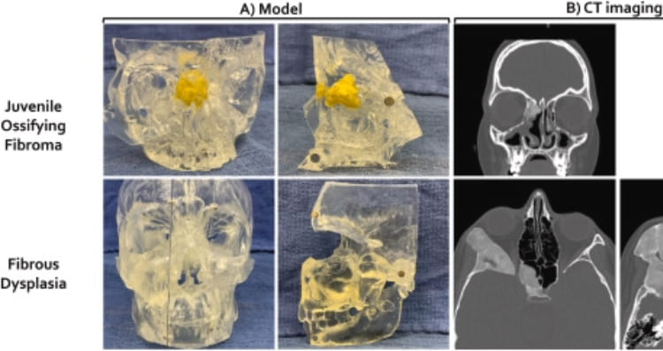 Use of Patient-specific 3D Printed Models in Preoperative Counseling ...