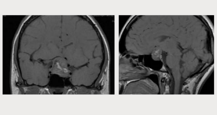 A Challenging Case of a Silent Somatotroph Adenoma | UPMC Physician ...